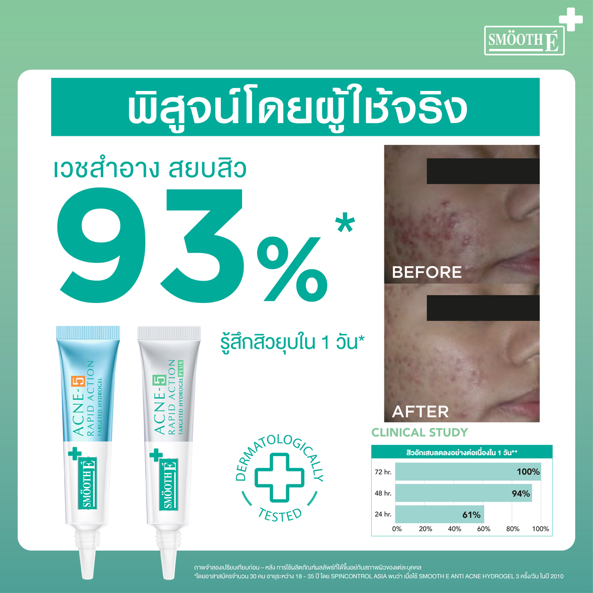[ใหม่!] Smooth E Acne-5 Rapid Action Plus 10g. เจลแต้มสิว สำหรับผิวบอบ ...