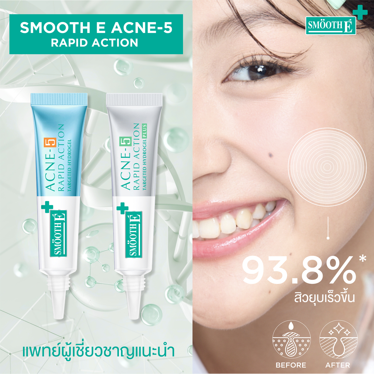 [ใหม่!] Smooth E Acne-5 Rapid Action Plus 10g. เจลแต้มสิว สำหรับผิวบอบ ...