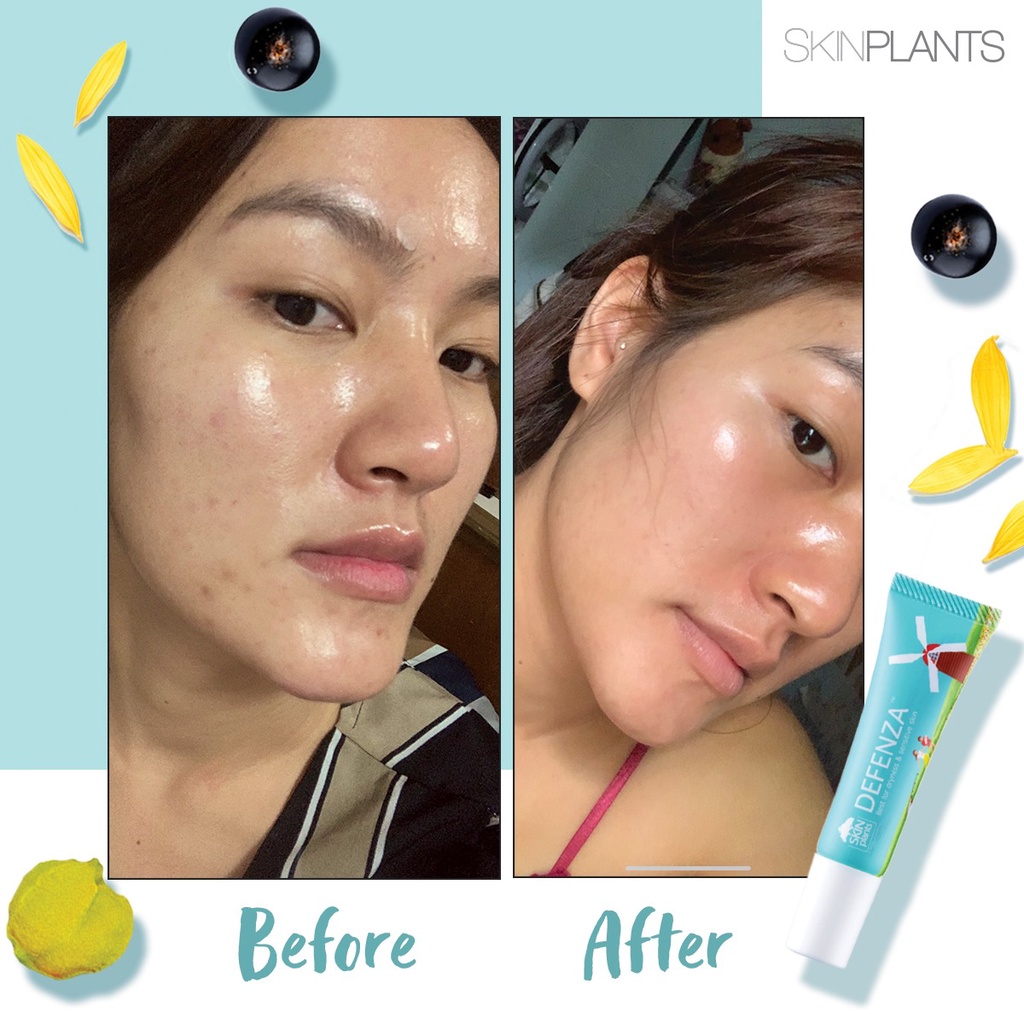 SKINPLANTS Defenza Cream 12 g. ครีมแก้แพ้ ทางออกผิวติดสาร แก้คัน ลดผดผื่น เซ็บเดิร์ม บรรเทาการ ...