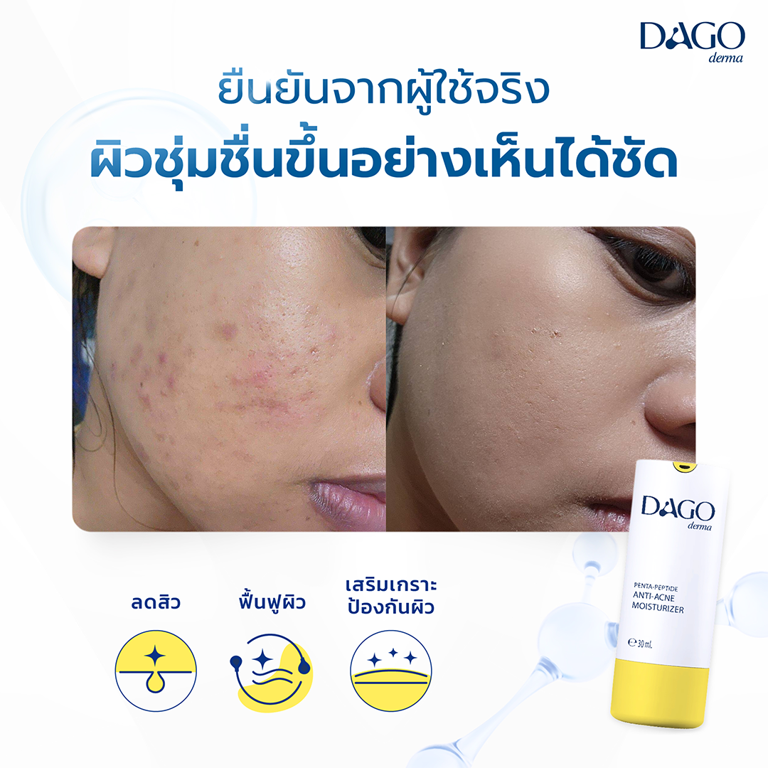 [แถมกิ็ฟ] มอยเจอร์ไรเซอร์ คุมมัน Dagoderma ลดรอยสิว ชุ่มชื้นยาวนาน ...