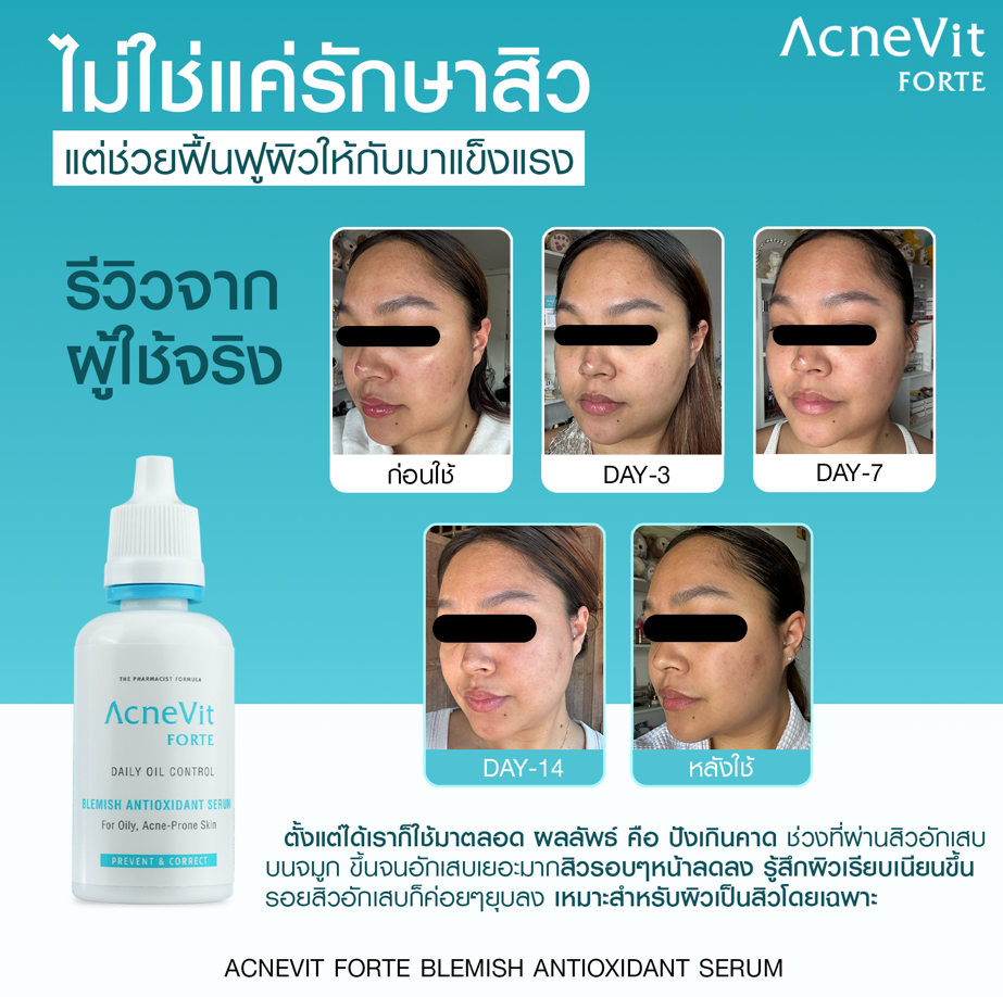 Acnevit Forte Blemish Antioxidant Serum 30ml (เซรั่ม AOXเพื่อคนผิวมัน ...
