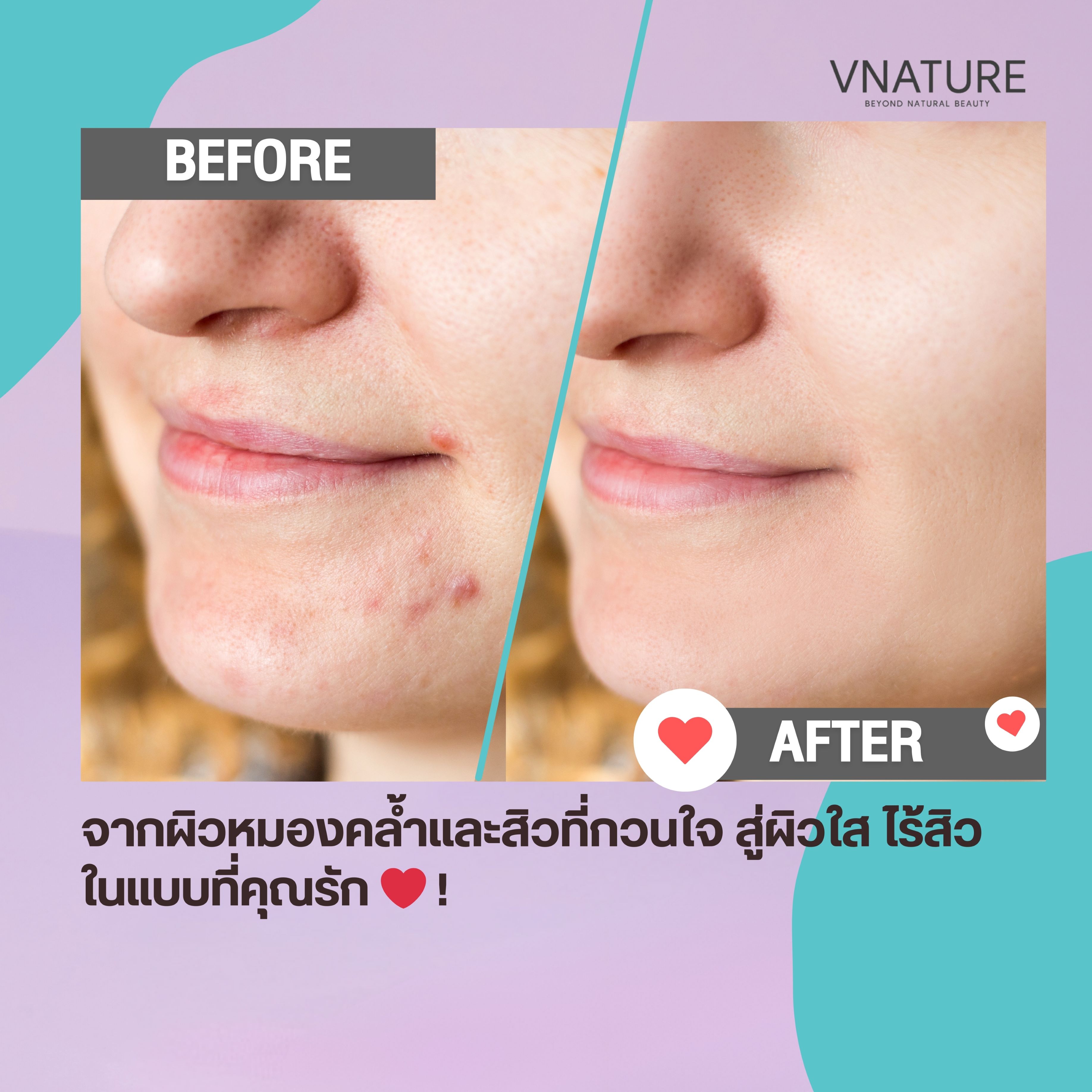 สบู่ลดสิว VNATURE Pimple & Whitening Soap 50 กรัม | Shopee Thailand