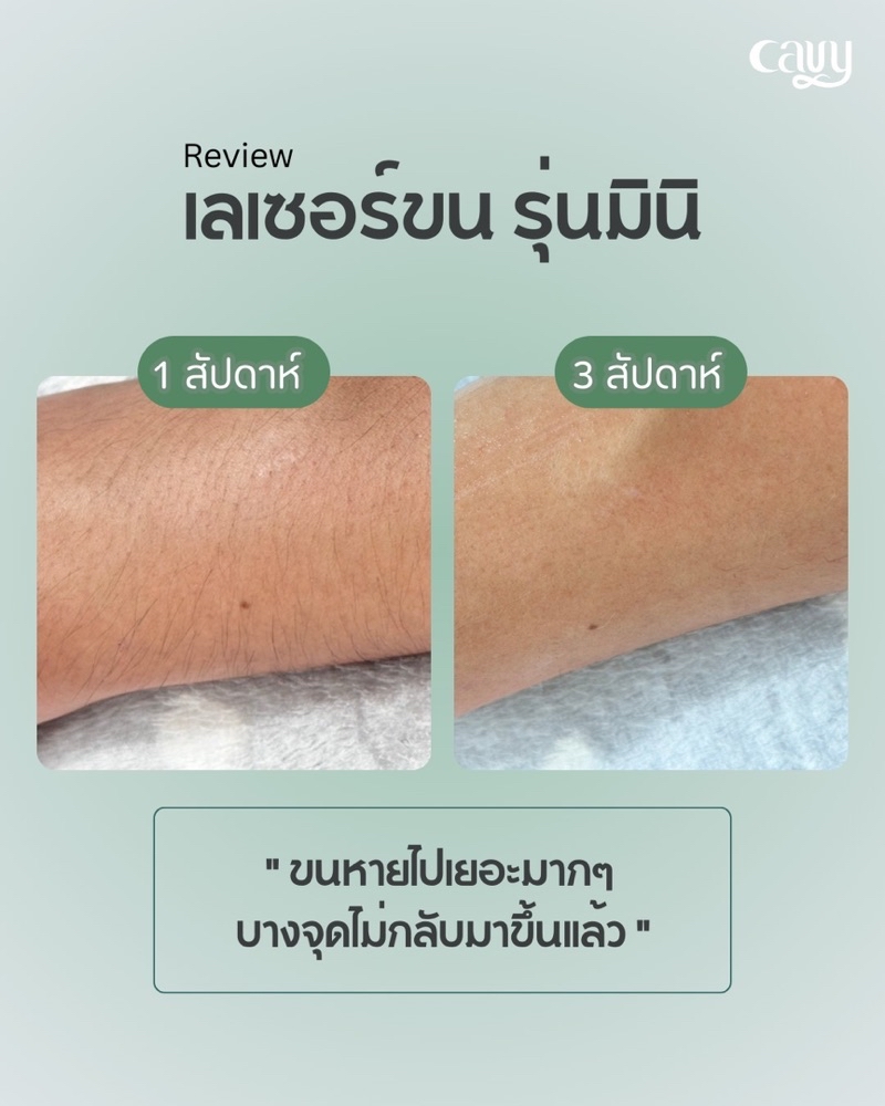 CAVY MINI IPL เครื่องเลเซอร์กำจัดขน หน้าใส ลดสิว 3 ฟังก์ชัน ไม่จำกัด ...