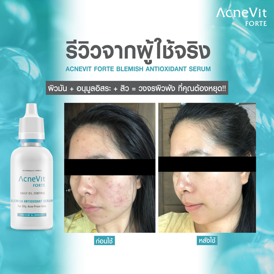 Acnevit Forte Blemish Antioxidant Serum 30ml (เซรั่ม AOXเพื่อคนผิวมัน ...
