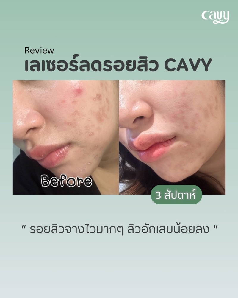 CAVY PLUS IPL เครื่องเลเซอร์กำจัดขน หน้าใส ลดสิว 3 ฟังก์ชัน พร้อมโหมด ...
